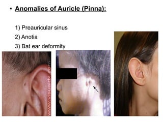 Anatomy & embryology ext ear & middle ear | ODP