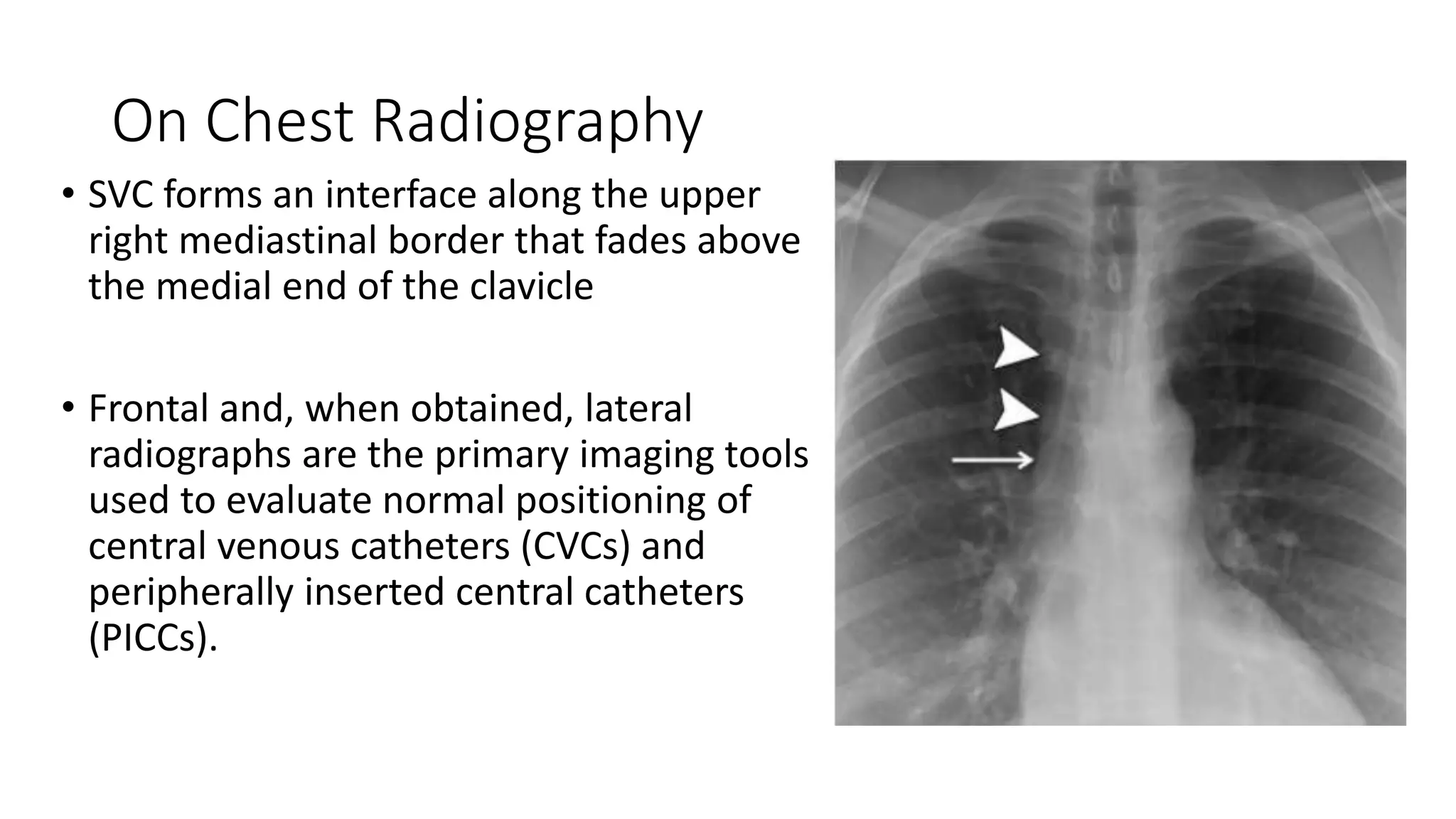 ANATOMY EMBRYOLOGY AND IMAGING OF SVC.pptx