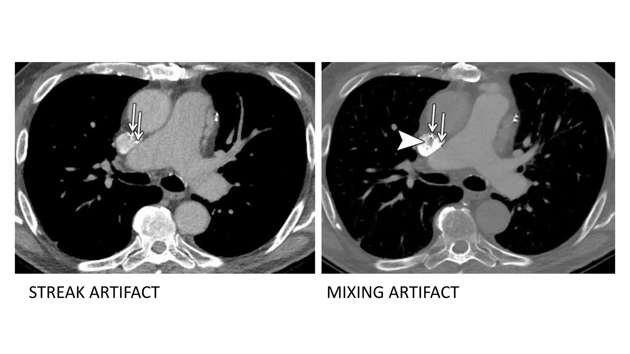 ANATOMY EMBRYOLOGY AND IMAGING OF SVC.pptx