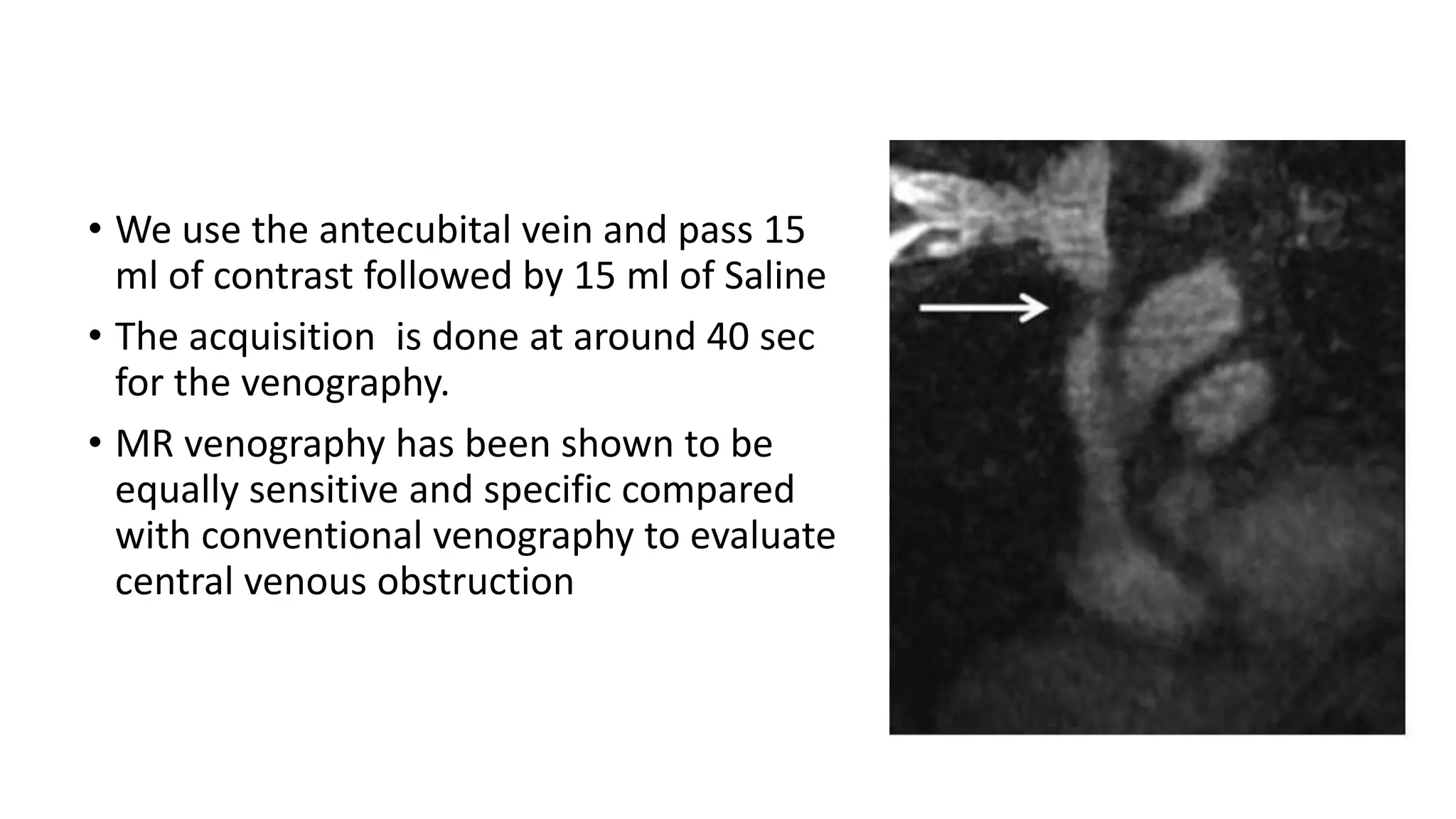 ANATOMY EMBRYOLOGY AND IMAGING OF SVC.pptx