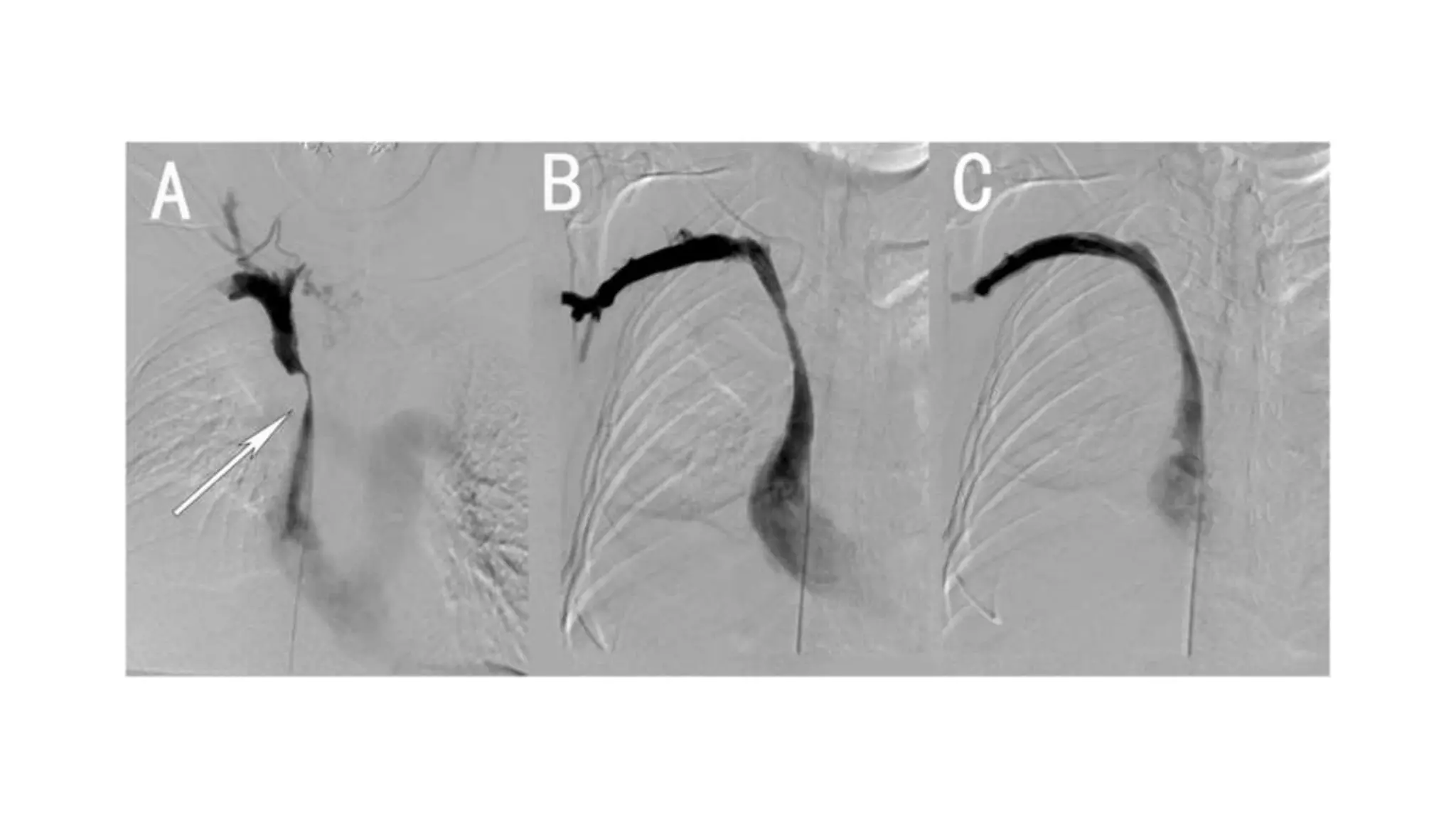 ANATOMY EMBRYOLOGY AND IMAGING OF SVC.pptx