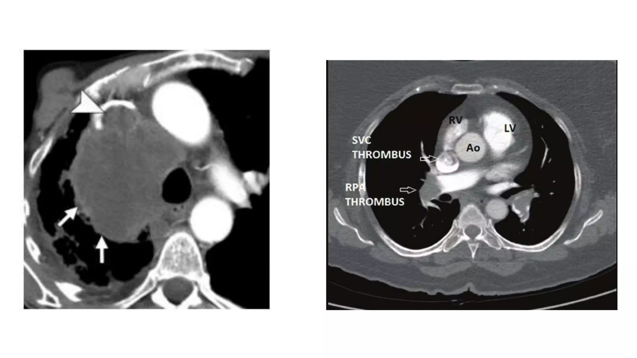 ANATOMY EMBRYOLOGY AND IMAGING OF SVC.pptx