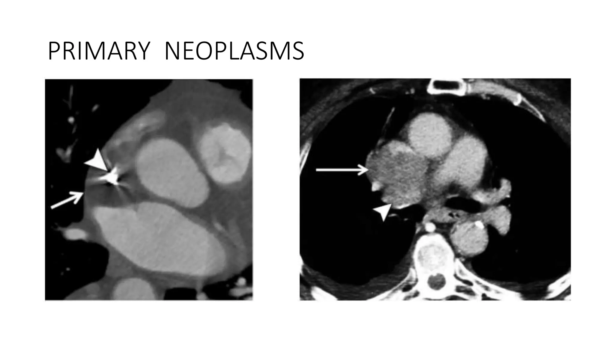 ANATOMY EMBRYOLOGY AND IMAGING OF SVC.pptx