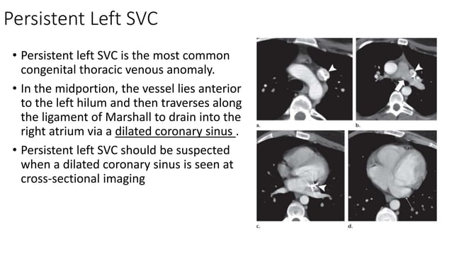 ANATOMY EMBRYOLOGY AND IMAGING OF SVC.pptx