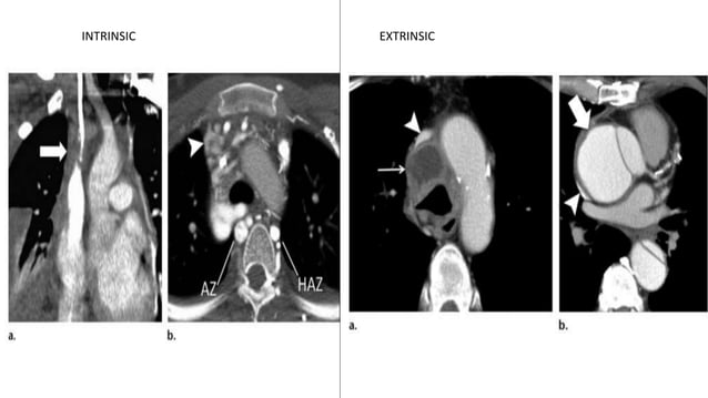 ANATOMY EMBRYOLOGY AND IMAGING OF SVC.pptx