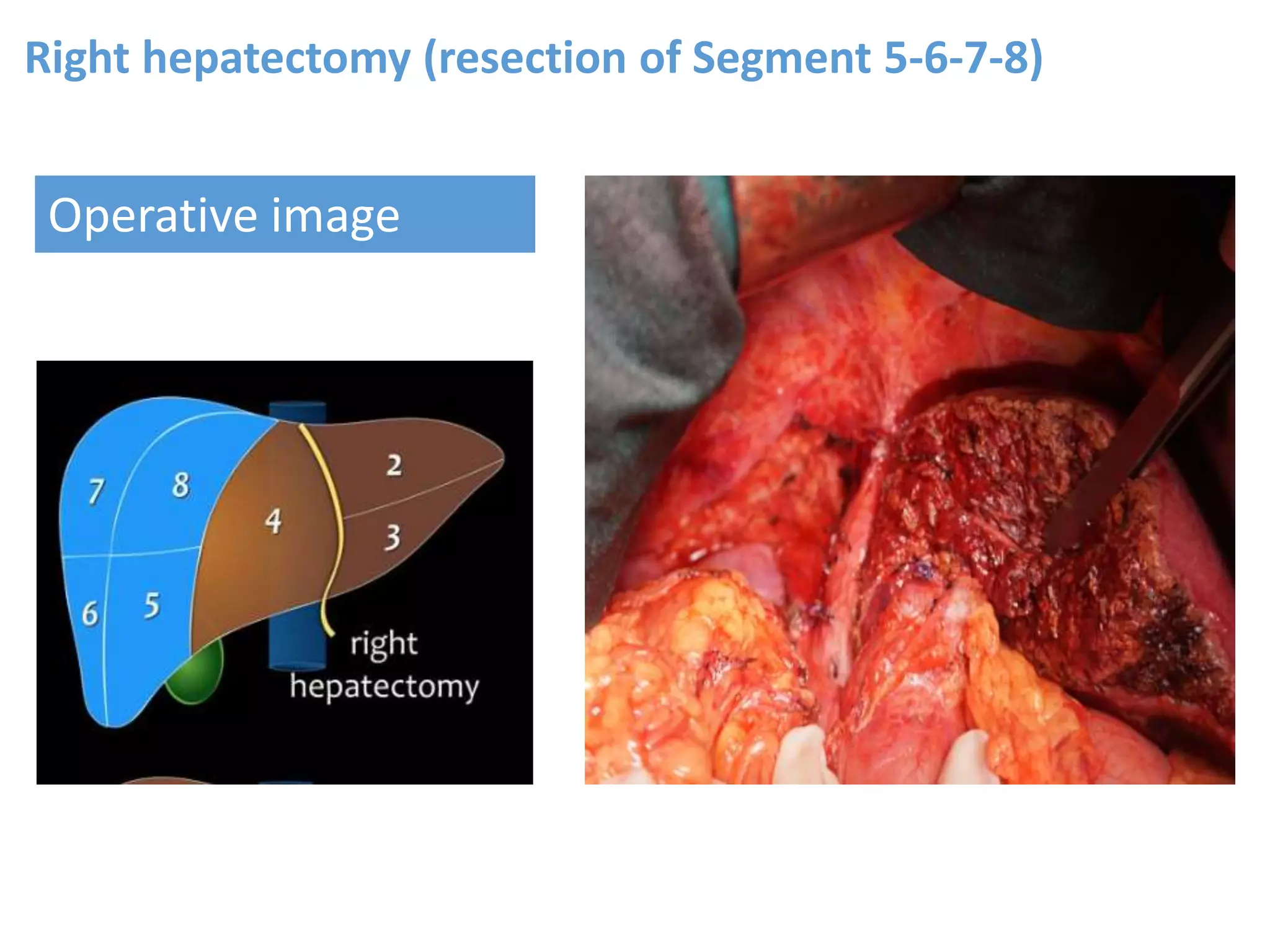 Anatomical liver resection | PPTX