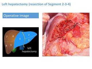 Anatomical liver resection | PPTX