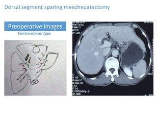 Anatomical liver resection | PPTX
