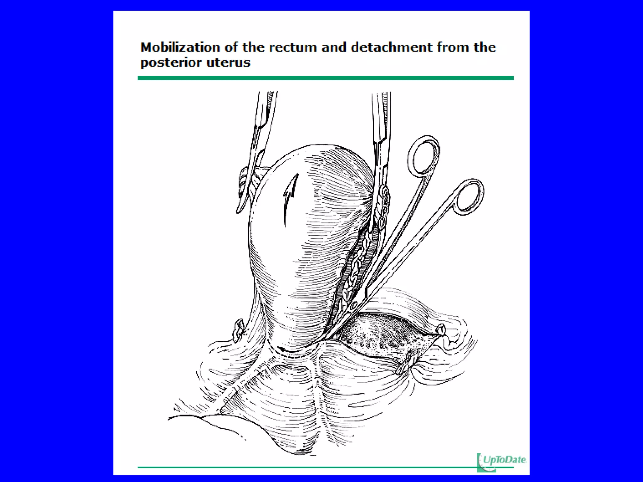 Anatomy for Hysterectomy | PPT