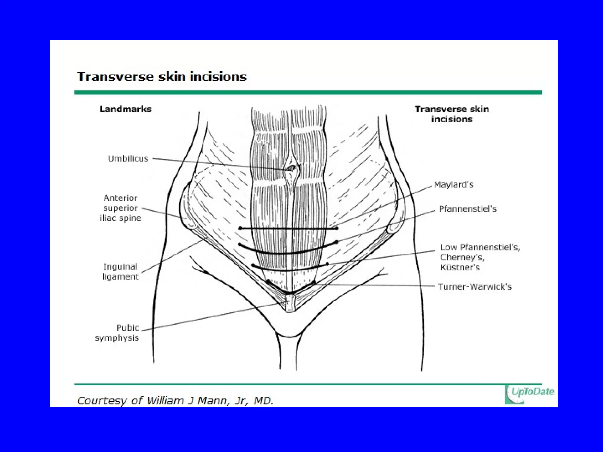 Anatomy for Hysterectomy | PPT