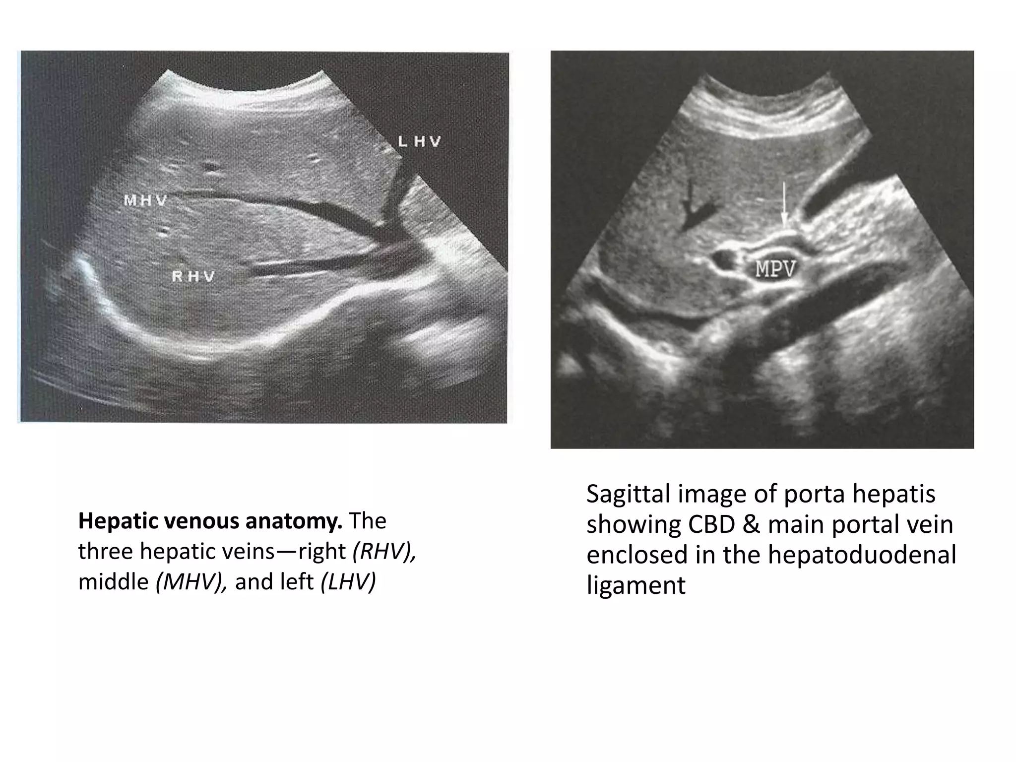 ANATOMY HEPATOBILIARY.pptx