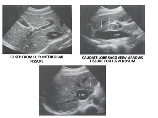 ANATOMY HEPATOBILIARY.pptx