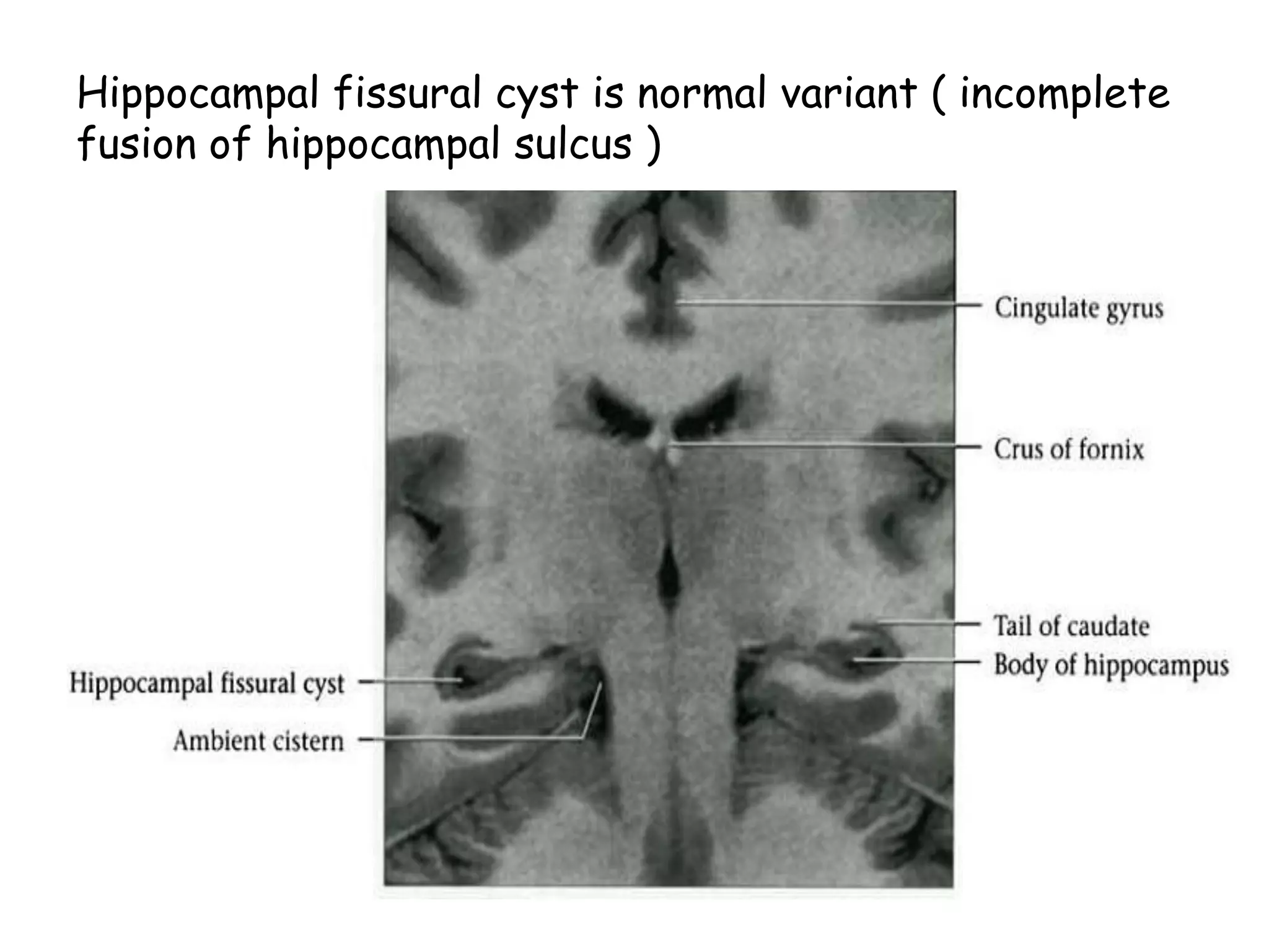 Anatomy of hippocampus ( radiology ) | PPTX