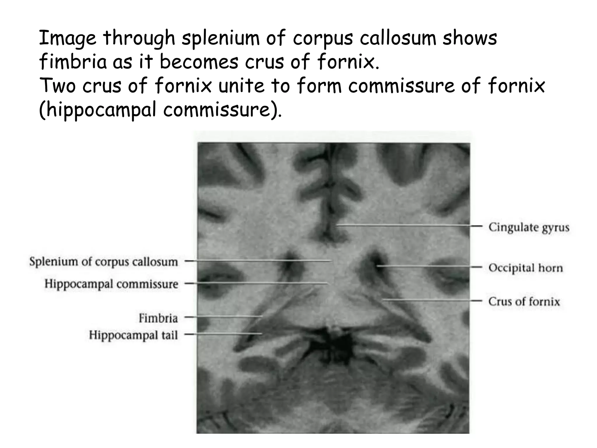 Anatomy of hippocampus ( radiology ) | PPTX