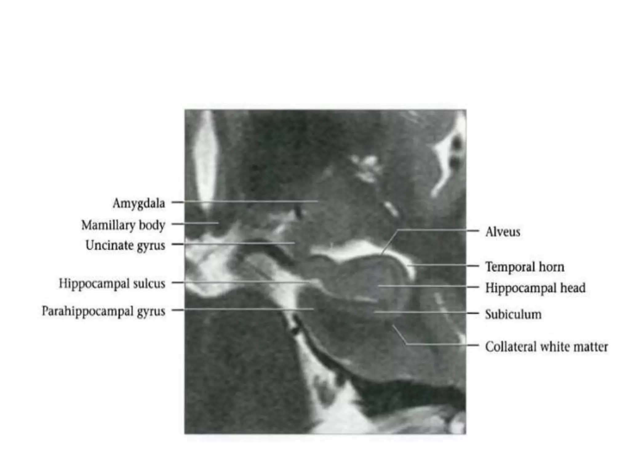Anatomy of hippocampus ( radiology ) | PPTX