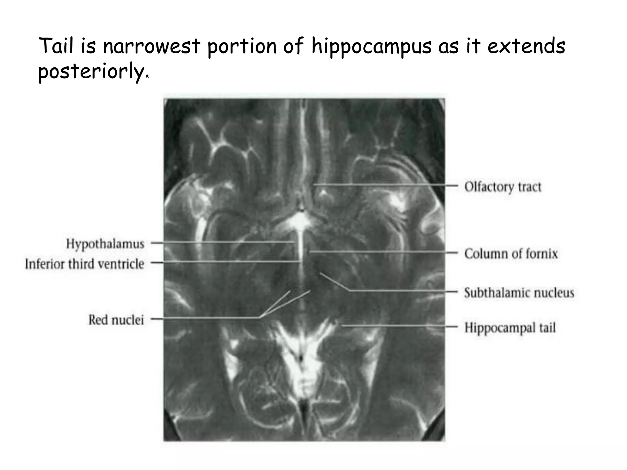 Anatomy of hippocampus ( radiology ) | PPTX