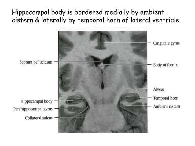 Anatomy of hippocampus ( radiology ) | PPTX | Brain and Nervous System ...