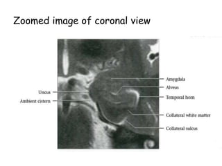 Hippocampus Anatomy Mri