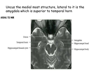 Hippocampus Anatomy Mri