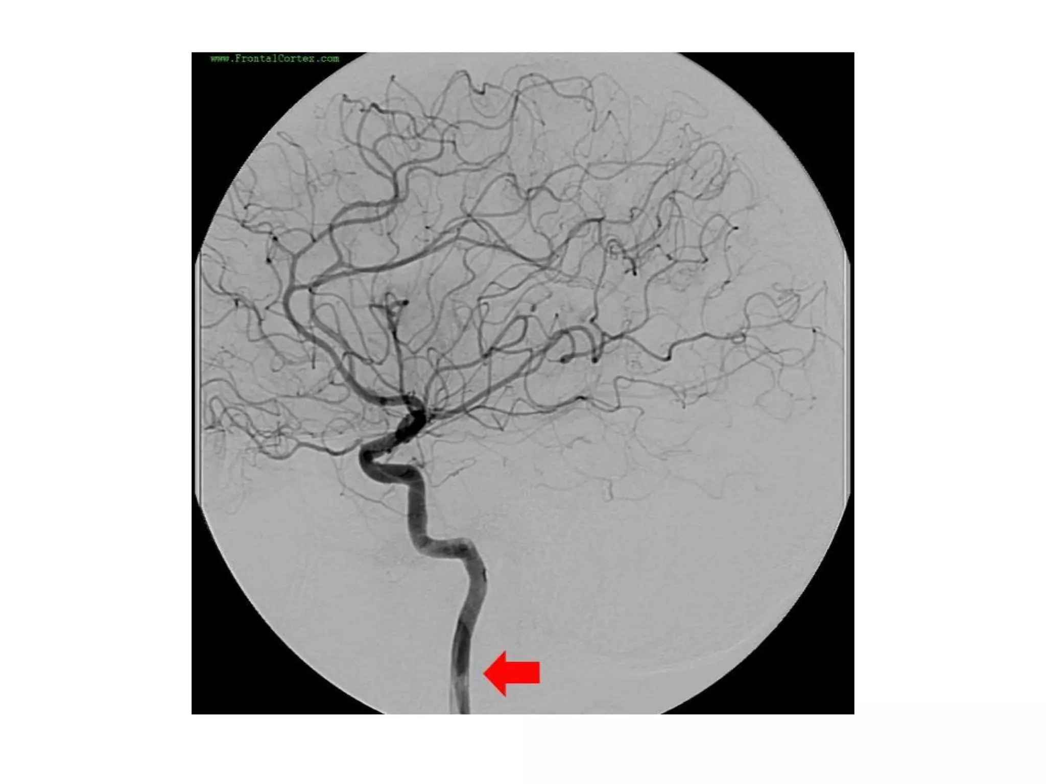 Interventional Neuroradiology: Anatomy of the internal carotid artery ...