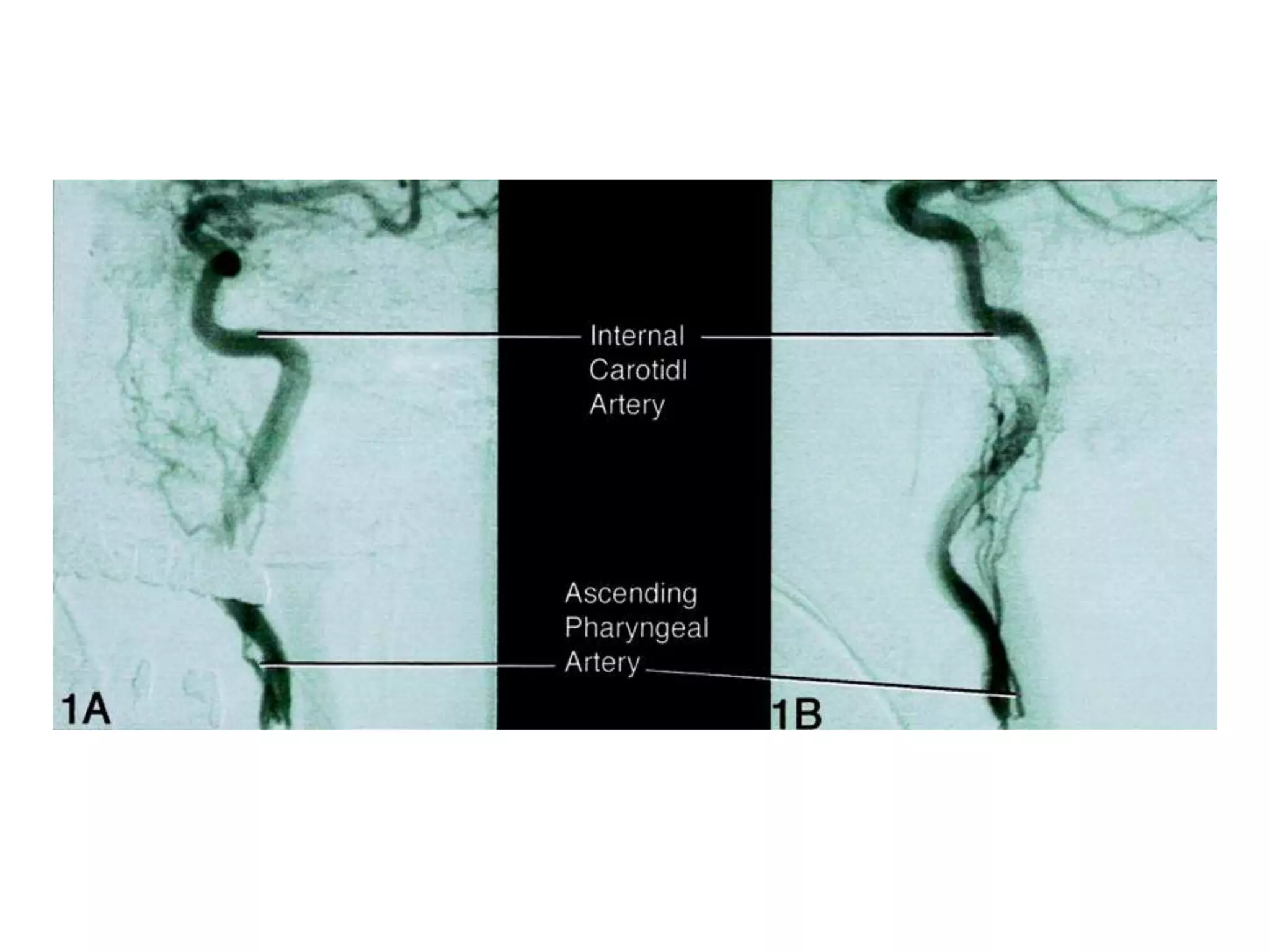 Interventional Neuroradiology: Anatomy of the internal carotid artery ...