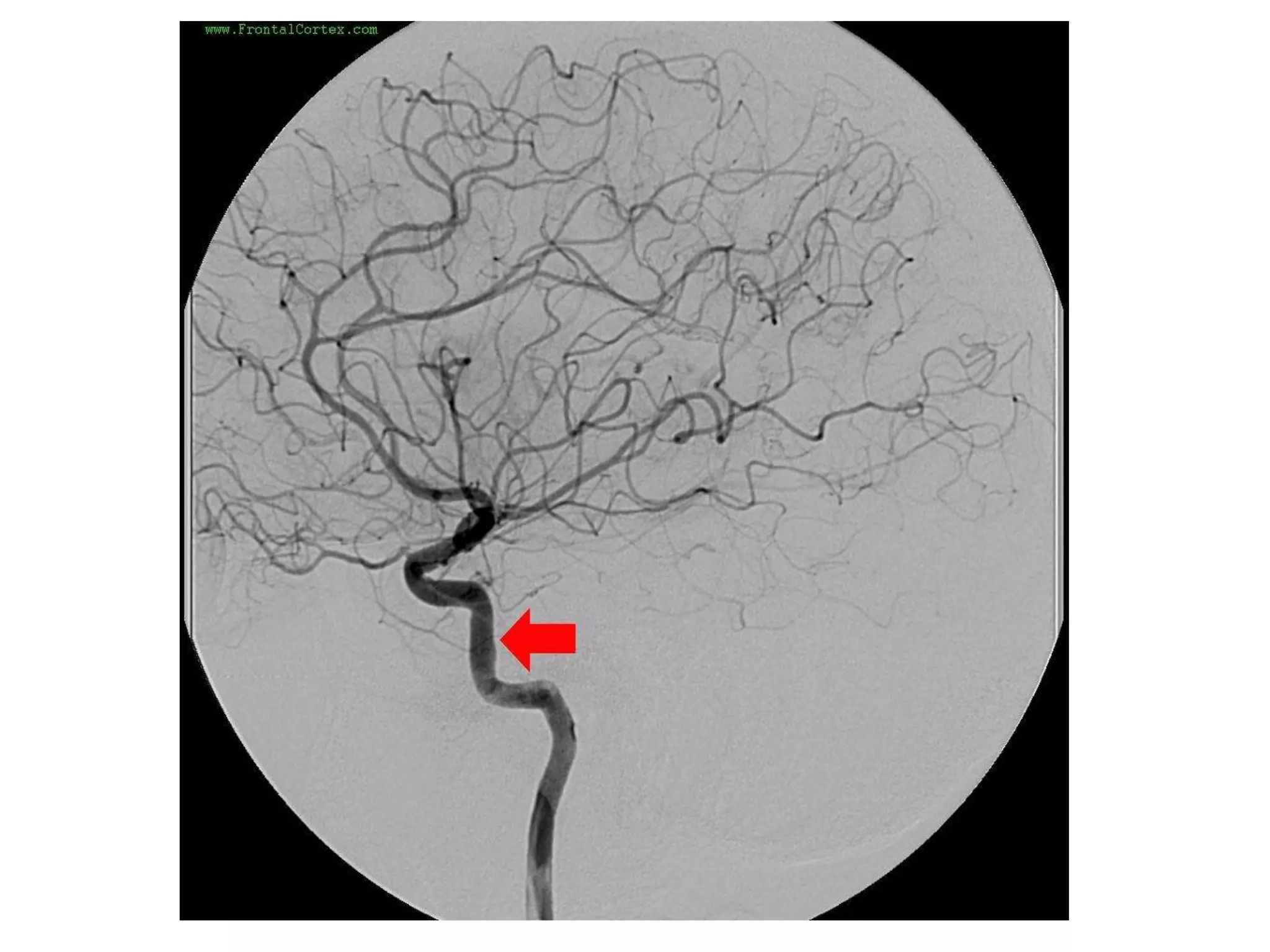 Interventional Neuroradiology: Anatomy of the internal carotid artery ...