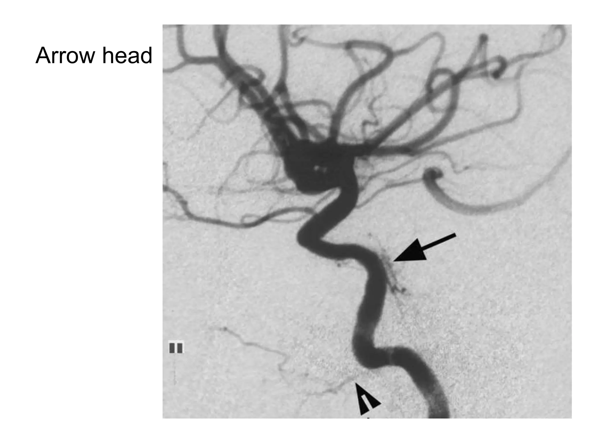 Interventional Neuroradiology: Anatomy of the internal carotid artery ...