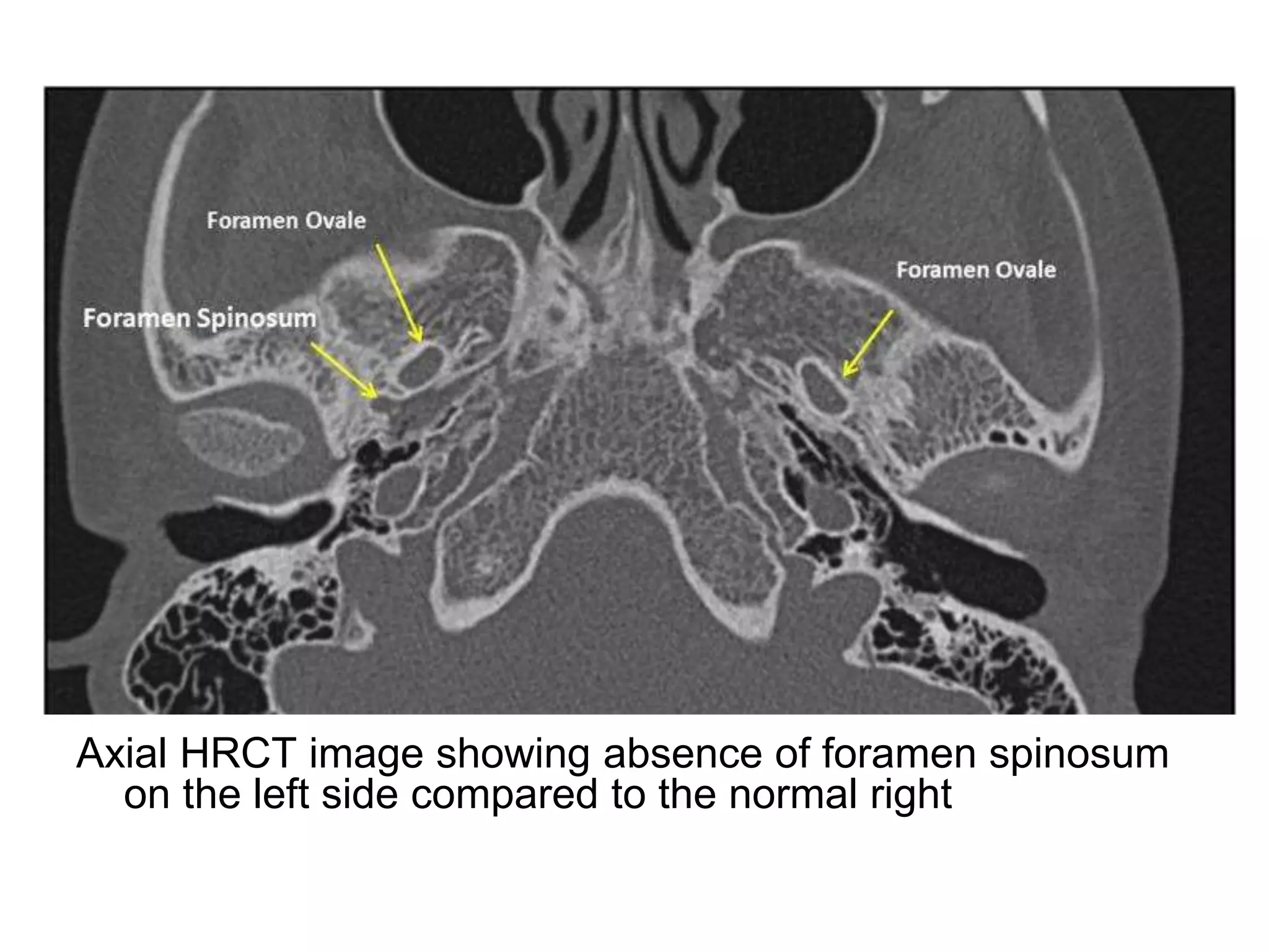Interventional Neuroradiology: Anatomy of the internal carotid artery ...