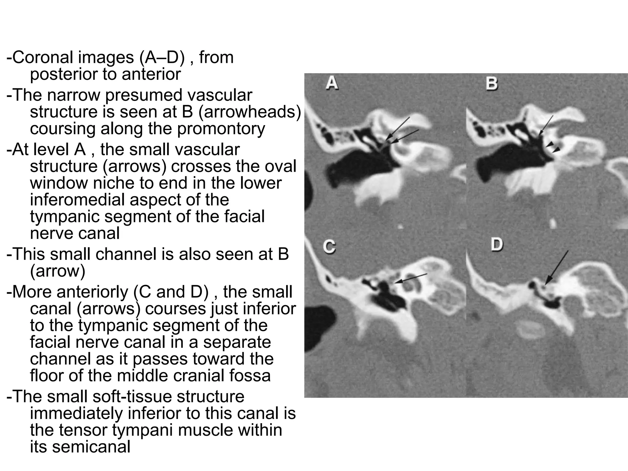 Interventional Neuroradiology: Anatomy of the internal carotid artery ...