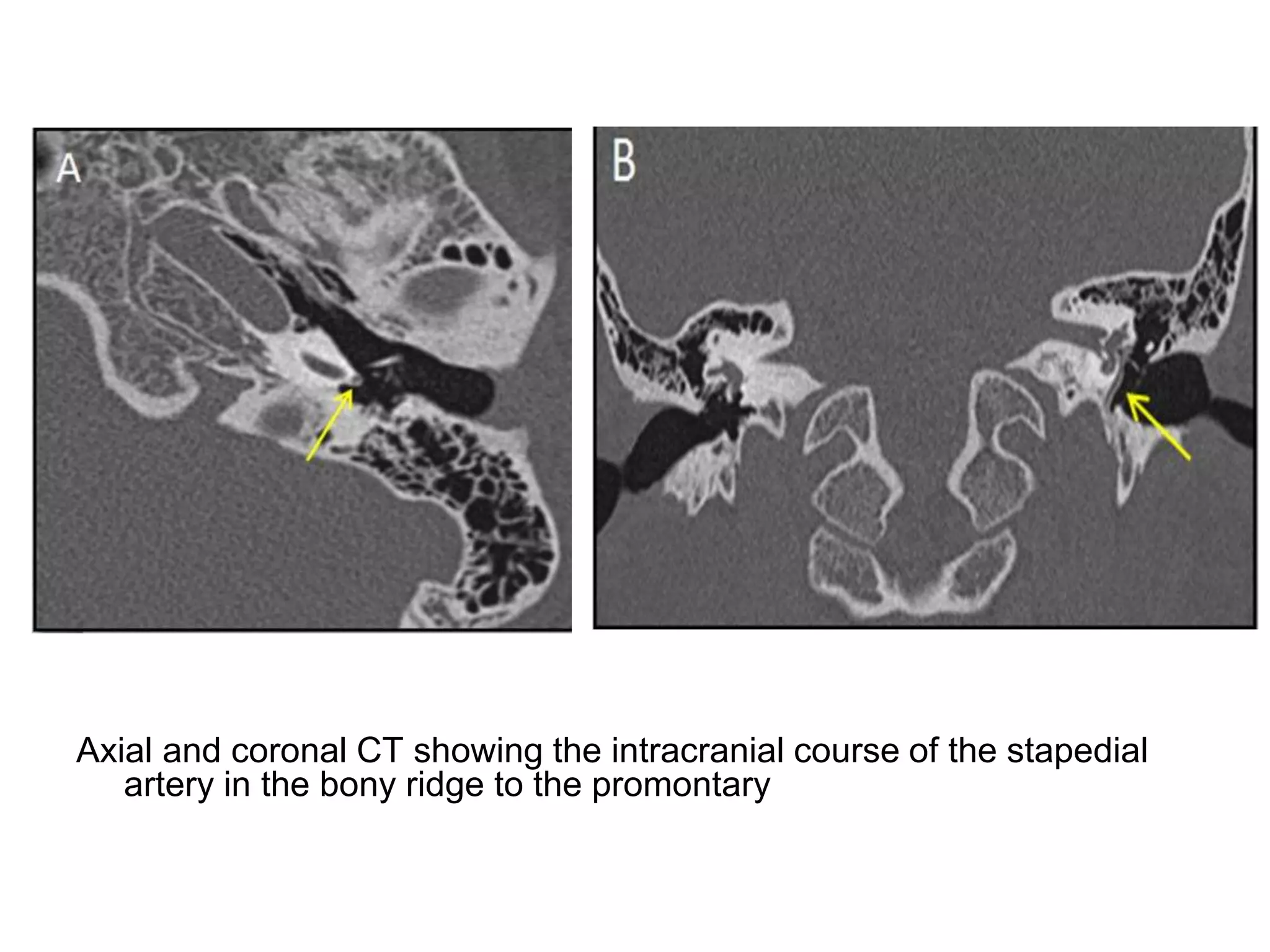 Interventional Neuroradiology: Anatomy of the internal carotid artery ...