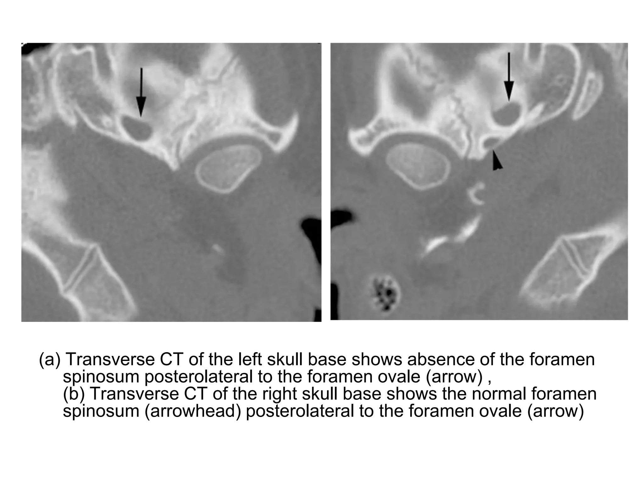 Interventional Neuroradiology: Anatomy of the internal carotid artery ...