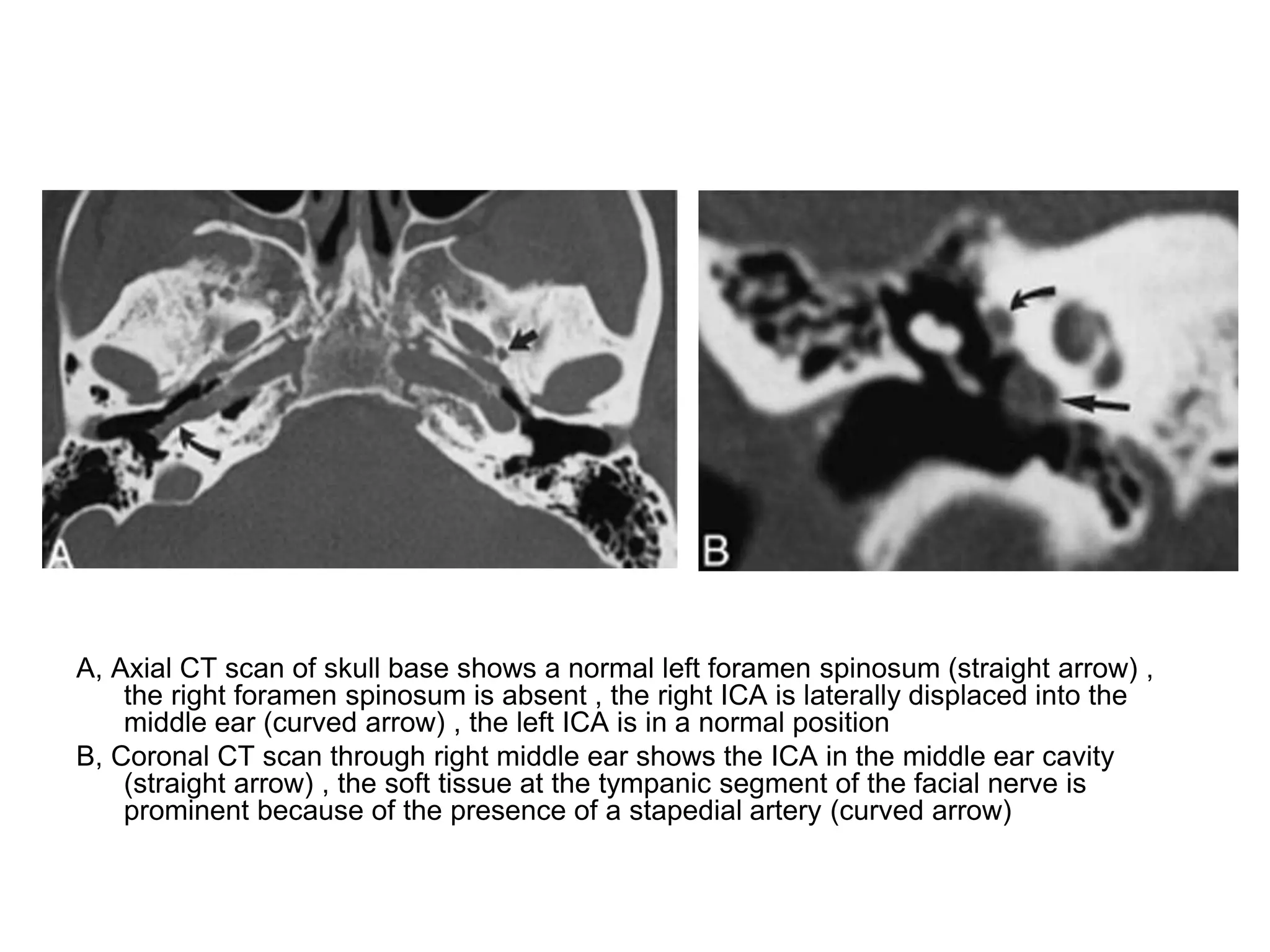 Interventional Neuroradiology: Anatomy of the internal carotid artery ...
