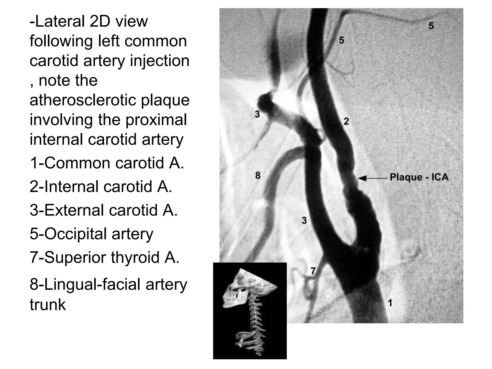 Interventional Neuroradiology: Anatomy of the internal carotid artery ...