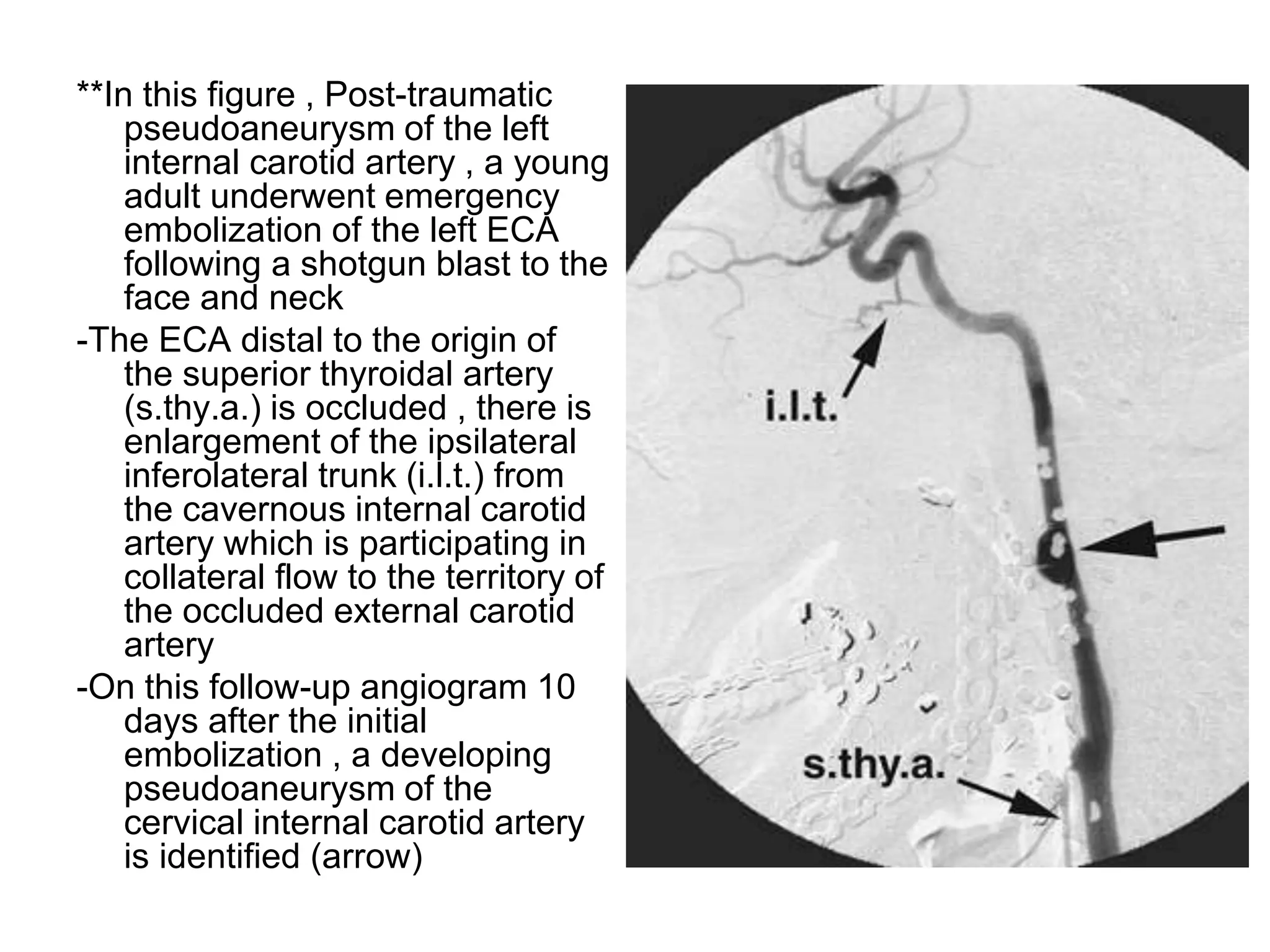 Interventional Neuroradiology: Anatomy of the internal carotid artery ...