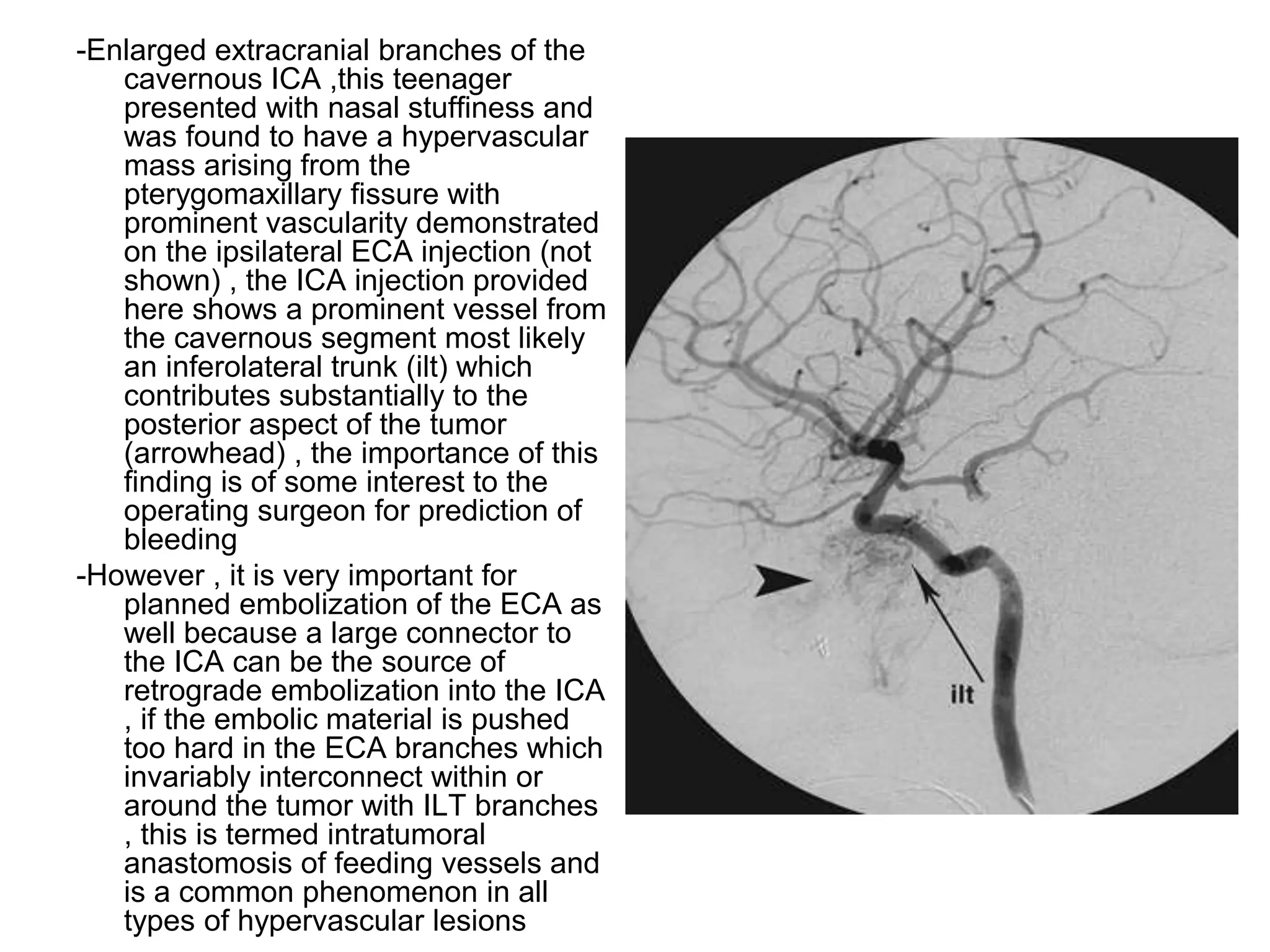 Interventional Neuroradiology: Anatomy of the internal carotid artery ...