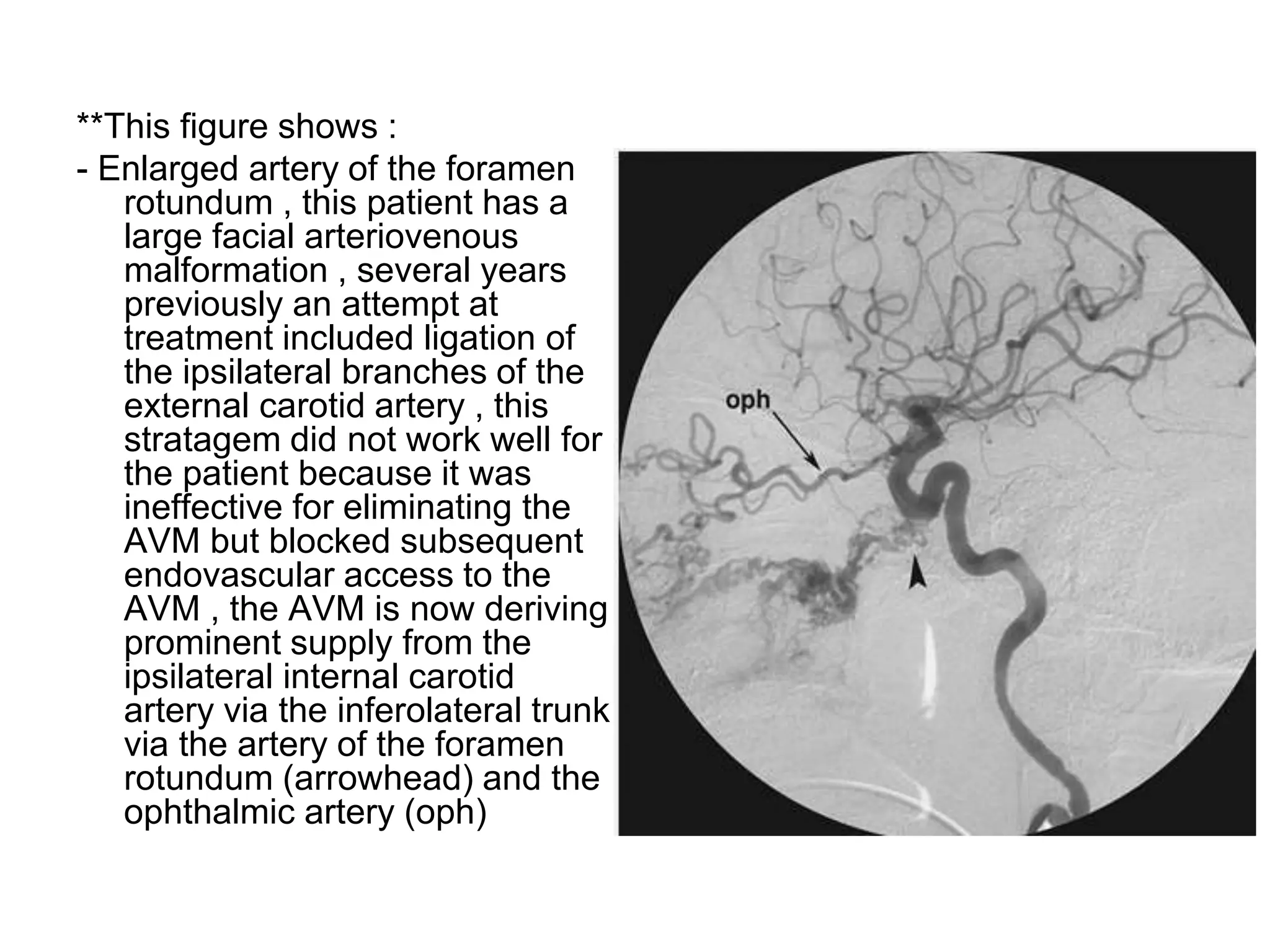 Interventional Neuroradiology: Anatomy of the internal carotid artery ...