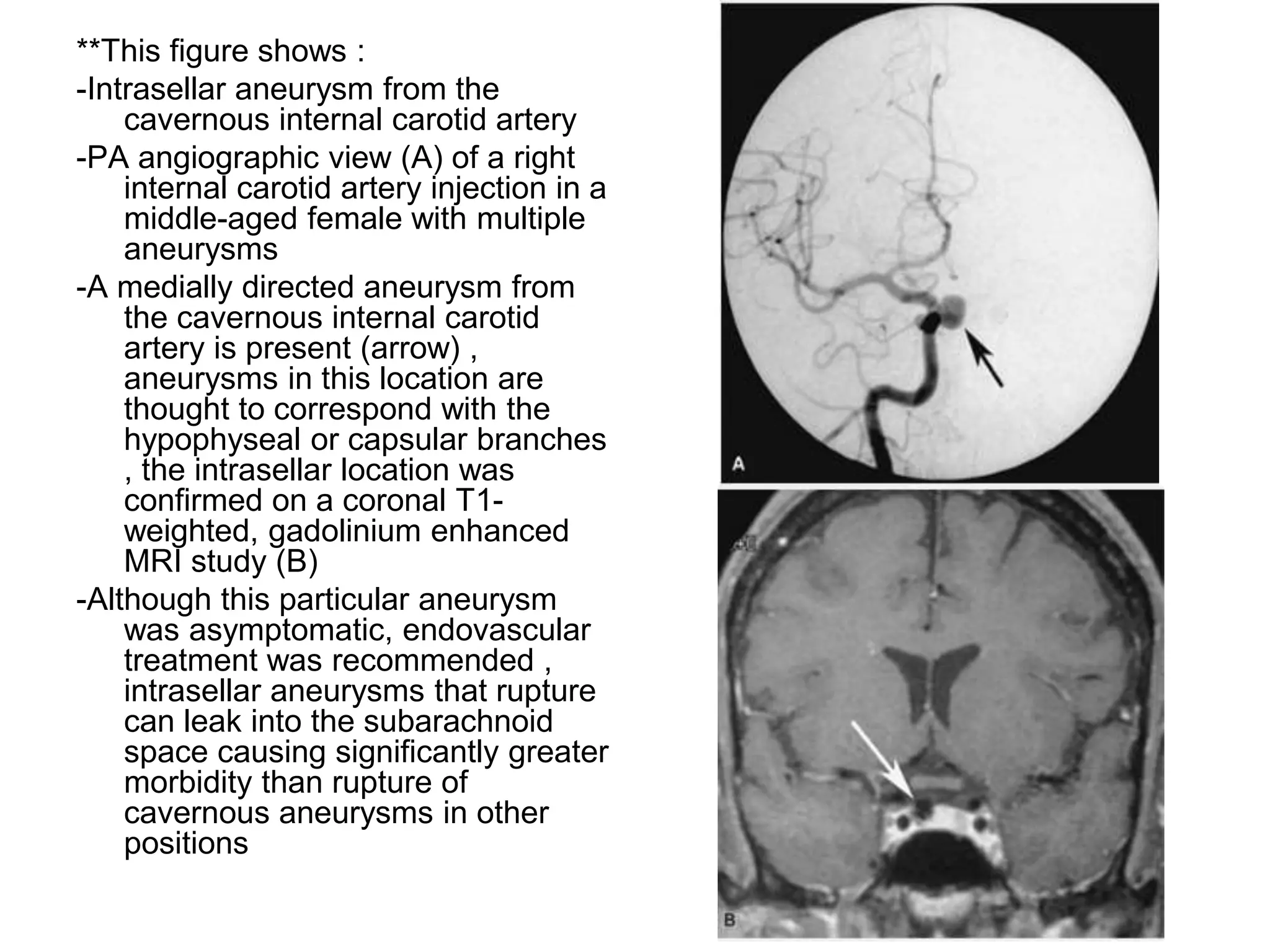 Interventional Neuroradiology: Anatomy of the internal carotid artery ...