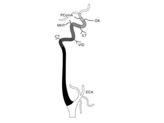 Interventional Neuroradiology: Anatomy of the internal carotid artery ...