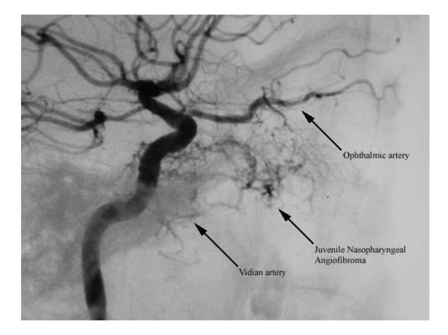 Interventional Neuroradiology: Anatomy of the internal carotid artery ...