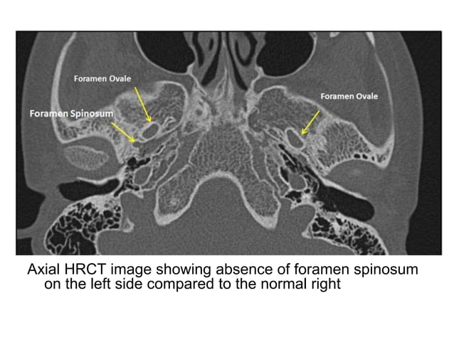 Interventional Neuroradiology: Anatomy of the internal carotid artery ...