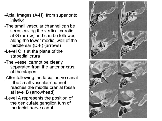 Interventional Neuroradiology: Anatomy of the internal carotid artery ...