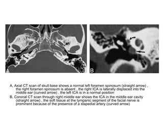 Interventional Neuroradiology: Anatomy of the internal carotid artery ...