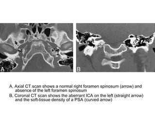 Interventional Neuroradiology: Anatomy of the internal carotid artery ...