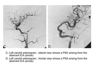 Interventional Neuroradiology: Anatomy of the internal carotid artery ...