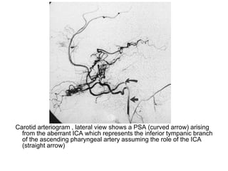Interventional Neuroradiology: Anatomy of the internal carotid artery ...