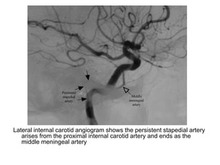 Interventional Neuroradiology: Anatomy of the internal carotid artery ...