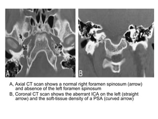 Interventional Neuroradiology: Anatomy of the internal carotid artery ...