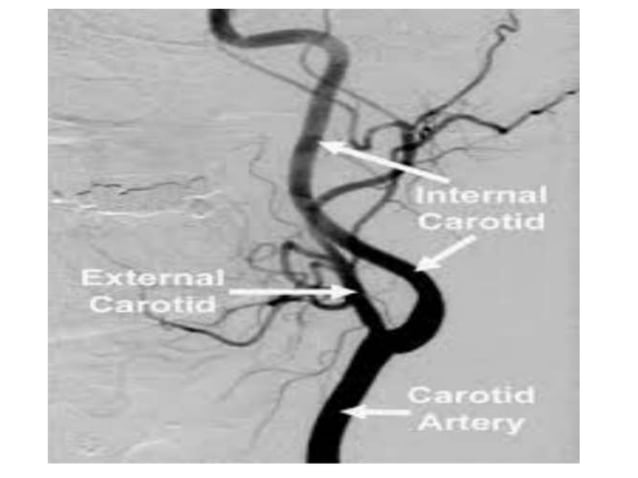 Interventional Neuroradiology: Anatomy of the internal carotid artery ...