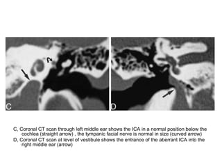 Interventional Neuroradiology: Anatomy of the internal carotid artery ...