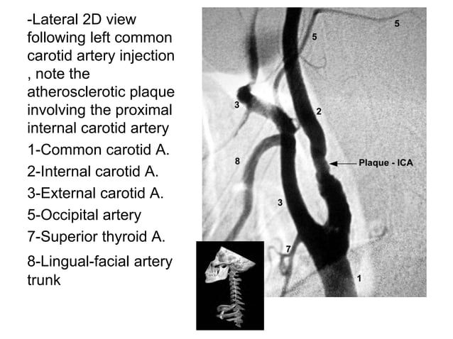 Interventional Neuroradiology: Anatomy of the internal carotid artery ...